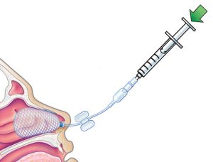 RAPID RHINO Product Usage Instructions - Μερκουρόπουλος Medical
