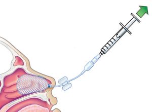 RAPID RHINO Product Usage Instructions - Μερκουρόπουλος Medical